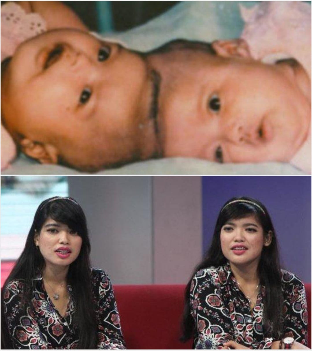 Cantiknya Yuliana - Yuliani Kembar Siam Dempet Kepala - posmo